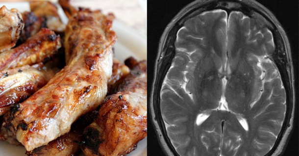18-Year-Old Passes Away From Eating Pork After Doctors Discover ...