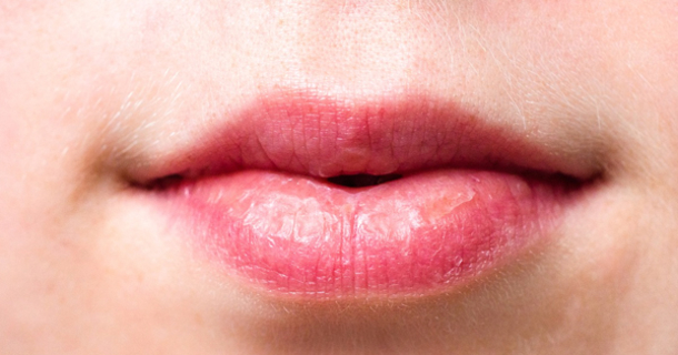 If you suffer from dry, chapped lips, here's a solution you need to ...