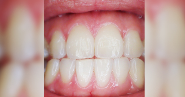 Healthy Gums Are A Must. Here Are 7+ Home Remedies To Battle Gum ...