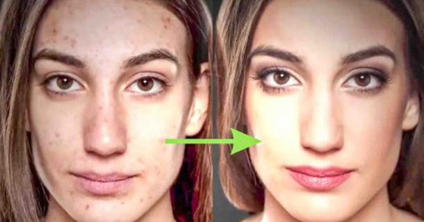 8 Fast Ways To Remove Acne Scars For Good