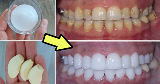 Say Goodbye to Yellow Teeth: Easy Home Remedies to Whiten Your Smile