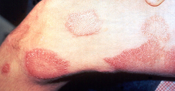 This Strange Disease Is Making A Comeback! Officials Say You Need To ...