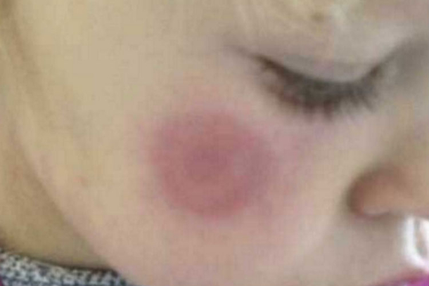If You Ever Notice A Mark Like This On Your Kid, Do Not Hesitate To ...