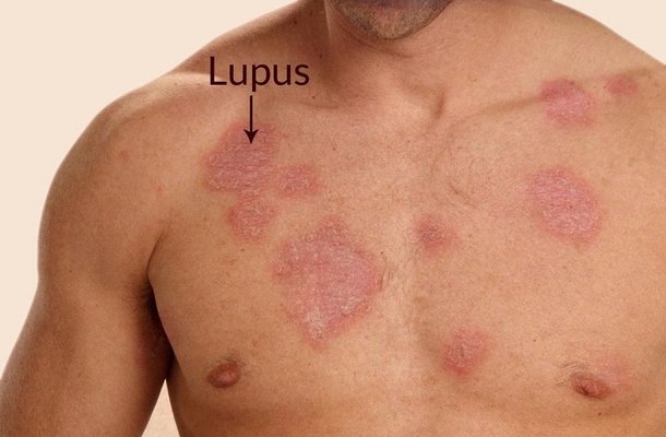 5 Strange And Unusual Facts About Lupus You Should Know