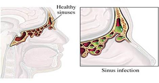 You Can Clear Your Sinuses In Under 30 Seconds With This Simple Trick