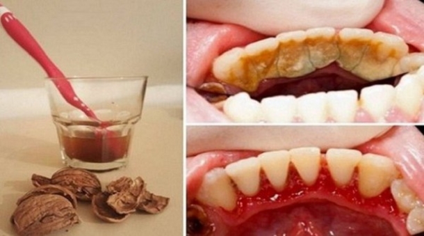 Get Rid of Tooth Plaque, Tartar and Bleeding Gums in a Very Simple And ...