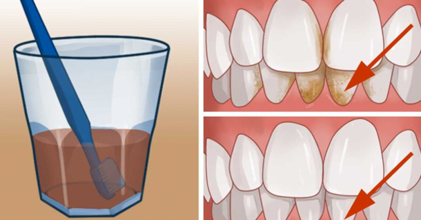 This Easy Remedy Will Help You Fight Tartar Build Up At Home