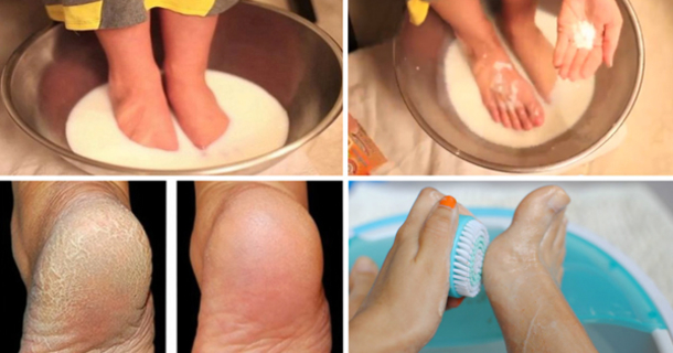 Don't Go Get A Pedicure, These 2 Kitchen Ingredients Will Make Your ...