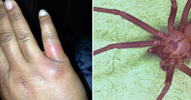 This Is Everything You Must Know If You Are Ever Bitten By This Deadly ...