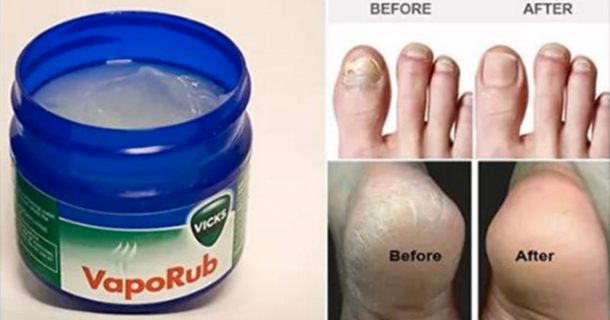 Here Are Some Ways To Use Vicks Vapor Rub That You May Not Have Heard Of.