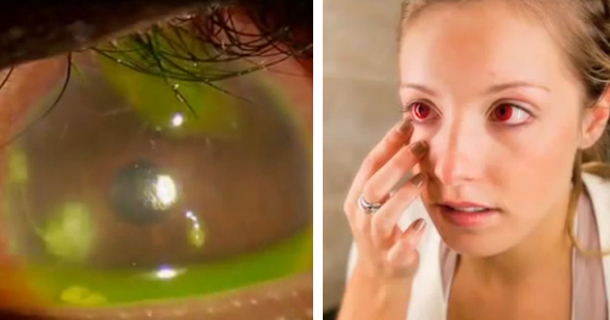 Teen Partially Blind In One Eye Due To Halloween Costume, Now She's ...