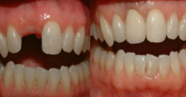 Incredible Discovery: Say Goodbye To The Dental Implants, Grow Your Own ...