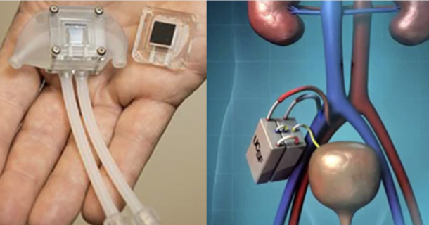 The World’s First Artificial Kidney Is Going To Replace Dialysis In The ...