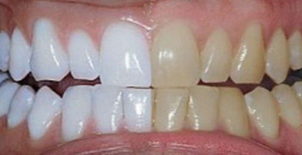 She Mixes THESE 2 Ingredients And Puts Them On Her Teeth. What It Does ...